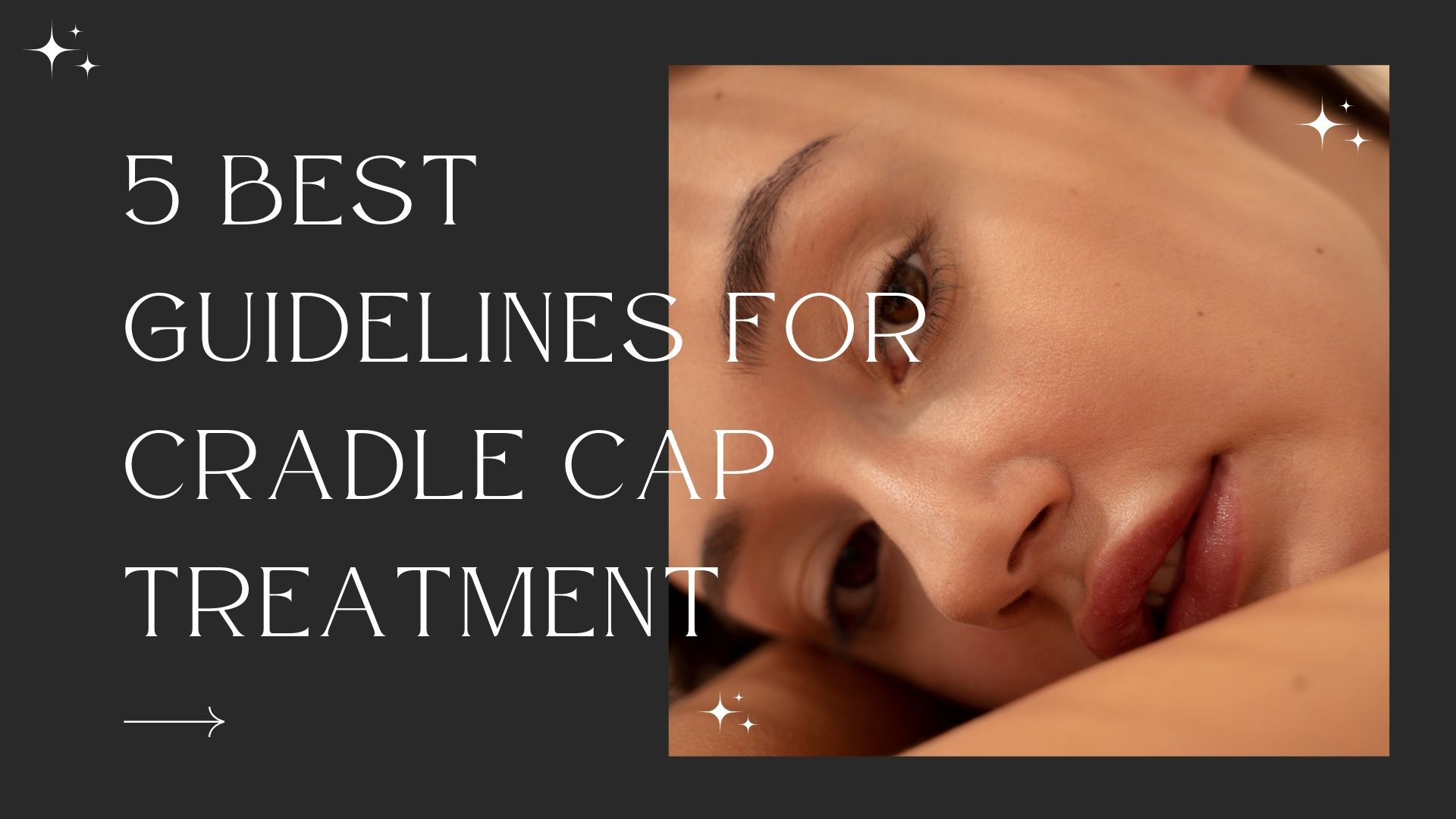 5 Best Guidelines For Cradle Cap Treatment - Toby and Roo